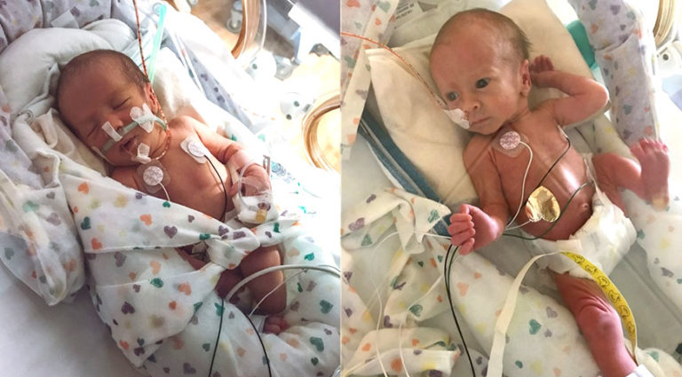 Preemie Twin Babies Receive Life-Saving Care - Hollywood Presbyterian ...